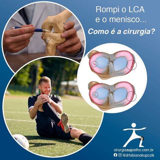 Rompi o LCA e o menisco... Como é a cirurgia? - Dr. Fabiano Kupczik