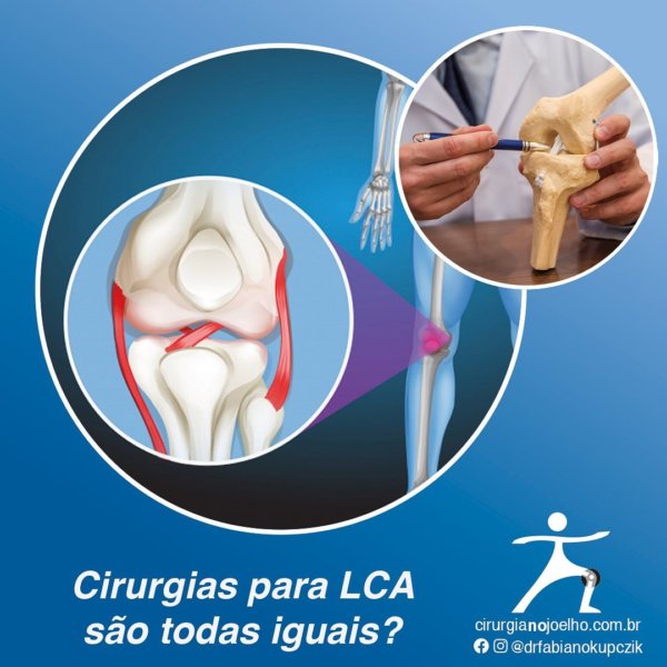 Cirurgias para LCA são todas iguais? - Dr. Fabiano Kupczik