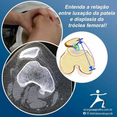 Entenda a relação entre luxação da patela e displasia da tróclea ...